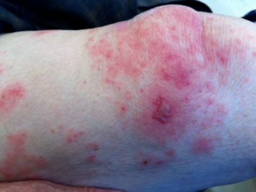 Shingles Facts That Help to Demystify the Disease