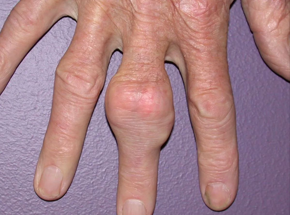 What Is Gout?: Symptoms, Dangers, and How to Avoid It